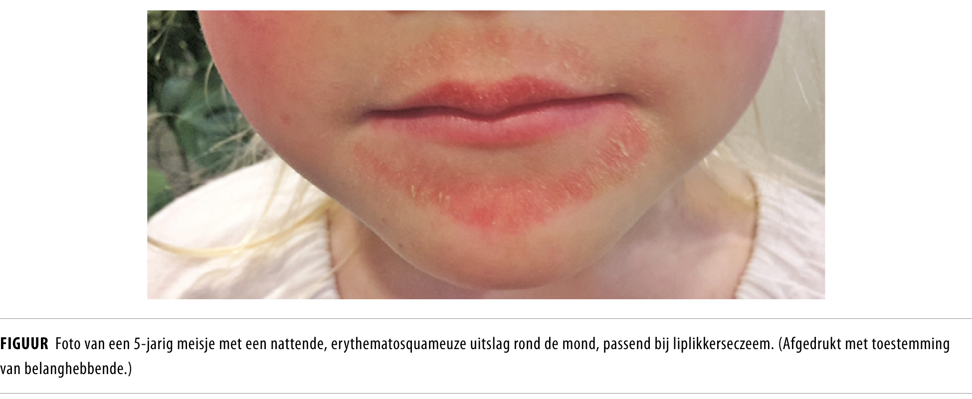 Een meisje met uitslag rond de mond | Nederlands Tijdschrift voor ...