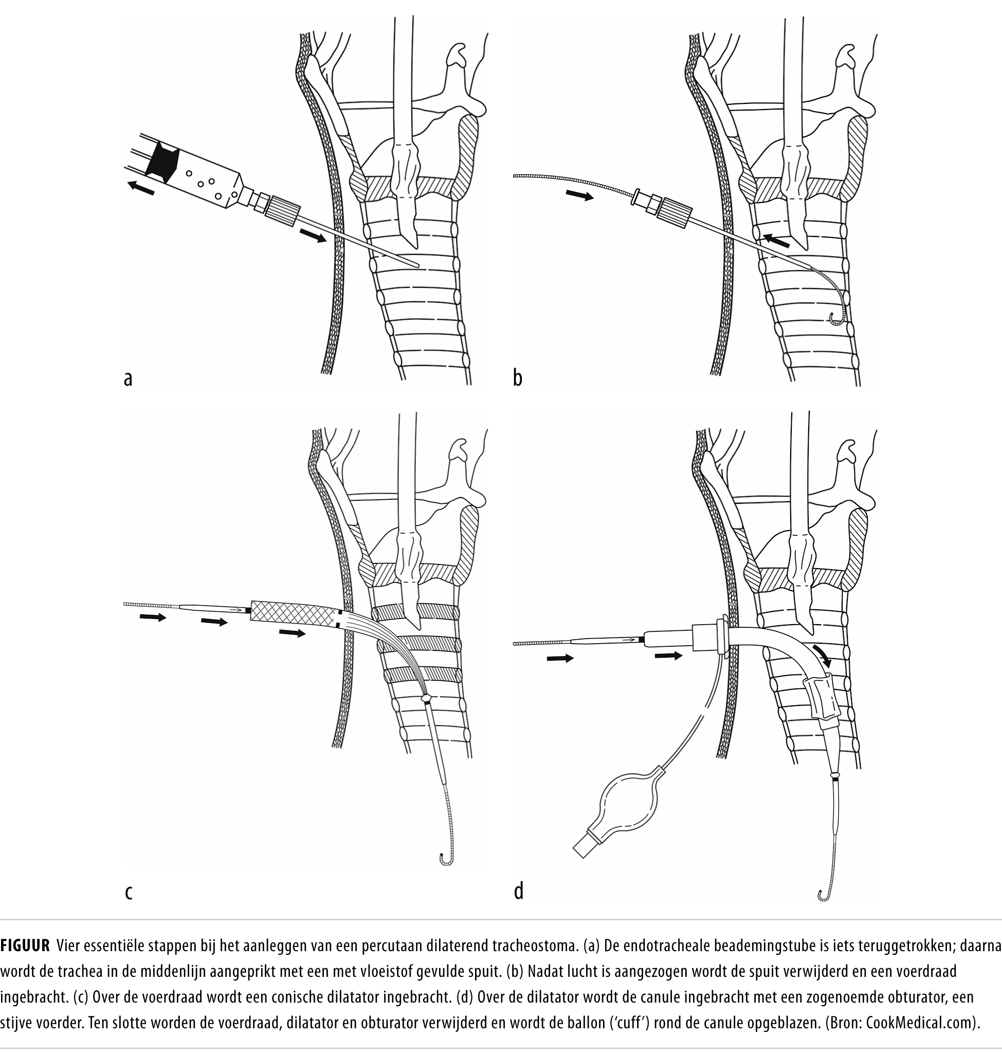 Tracheotomie op de intensive care is maatwerk | Nederlands Tijdschrift ...