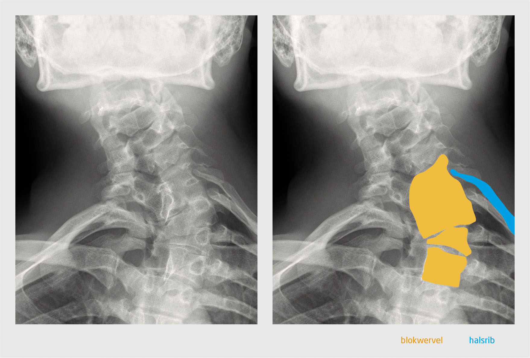 Tieners met een torticollis | Nederlands Tijdschrift voor Geneeskunde
