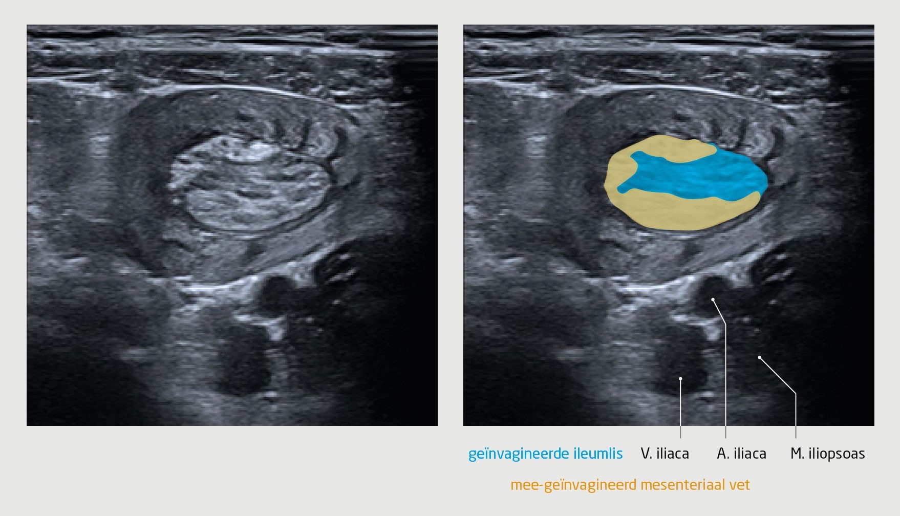 Keel- en buikklachten bij een maligne lymfoom | Nederlands Tijdschrift ...