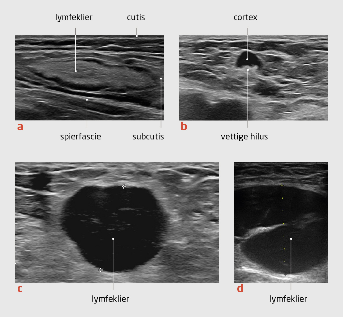 Radiologische beoordeling van lymfeklieren in de lies | Nederlands ...