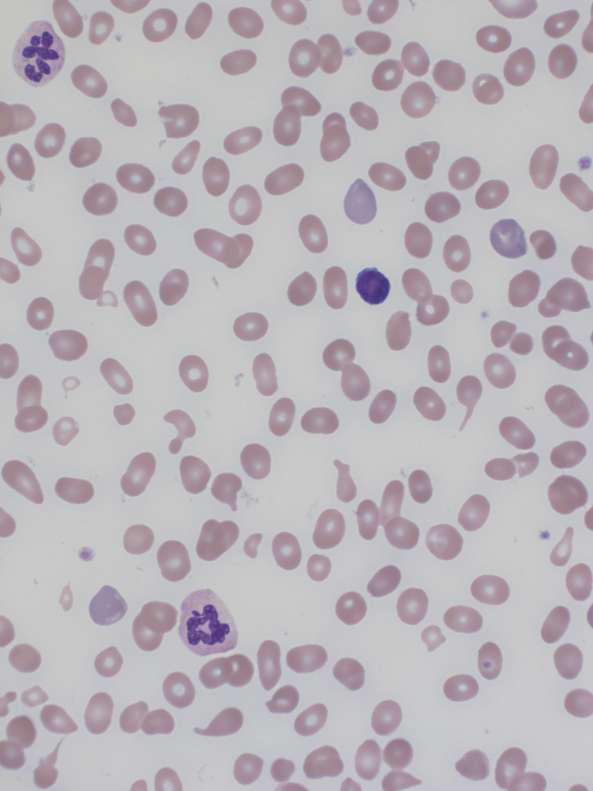 Een vermoeide vrouw met traandruppelcellen | Nederlands Tijdschrift ...