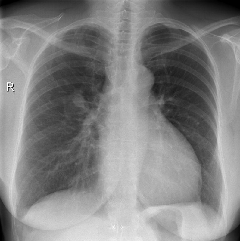 Een vrouw met een afwijking in de long | Nederlands Tijdschrift voor ...
