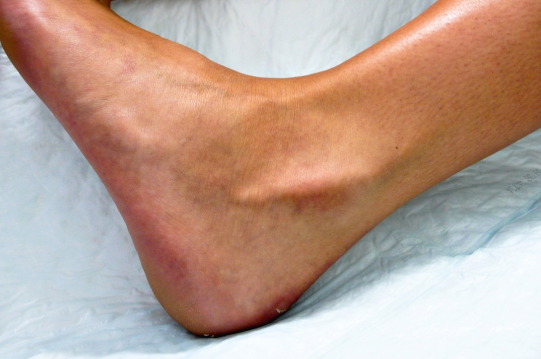 Een vrouw met een pijnlijke enkel | Nederlands Tijdschrift voor Geneeskunde