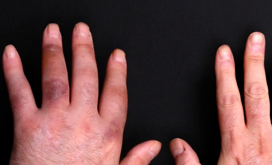 Een man met een pijnlijke en gezwollen hand | Nederlands Tijdschrift ...