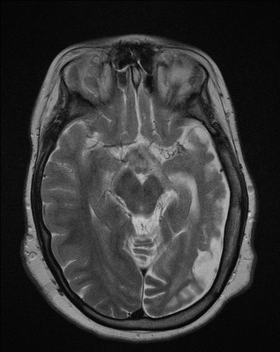 Een jonge vrouw met progressieve cerebrale atrofie | Nederlands ...