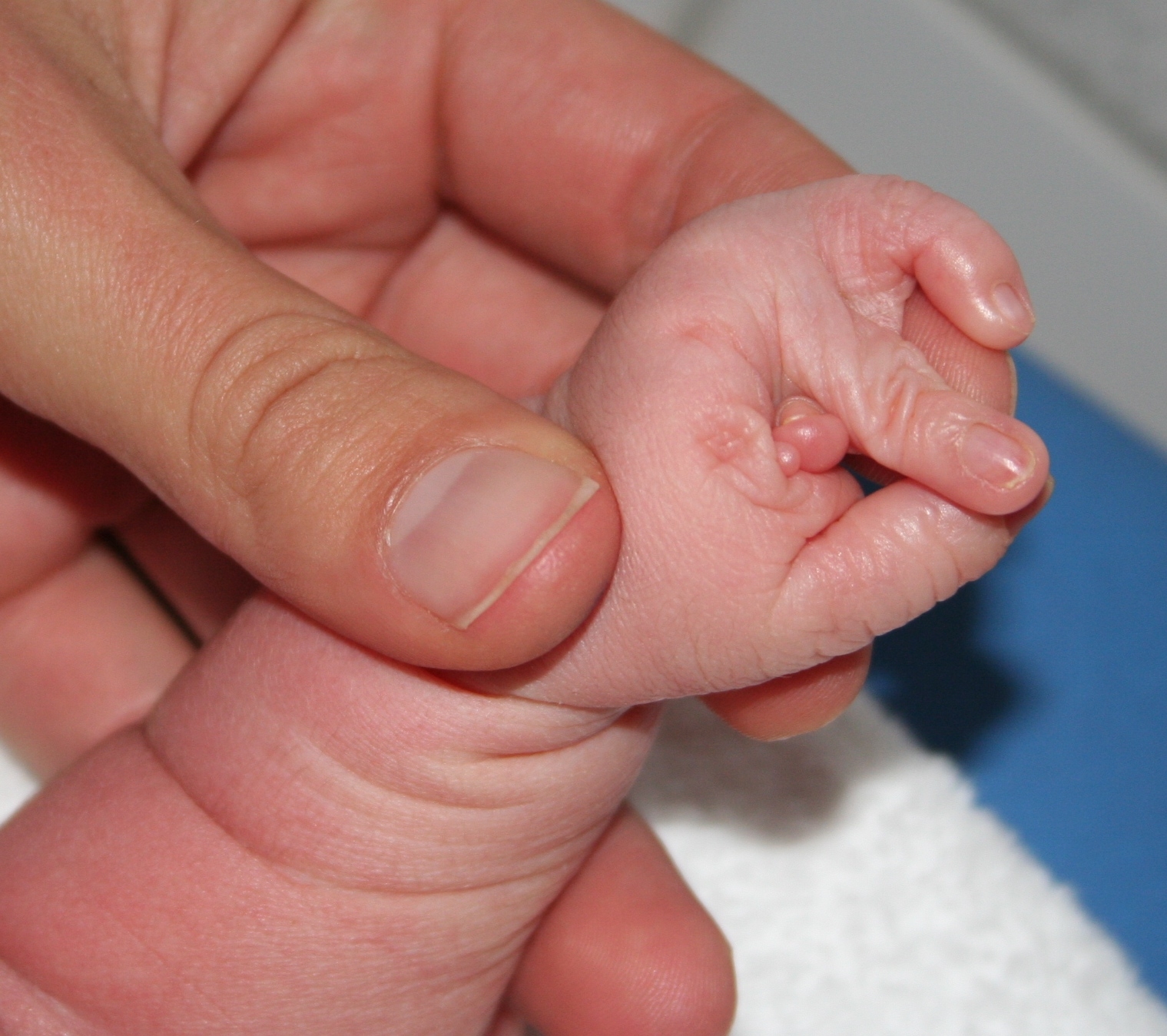 Een neonaat met een aangeboren handafwijking | Nederlands Tijdschrift ...