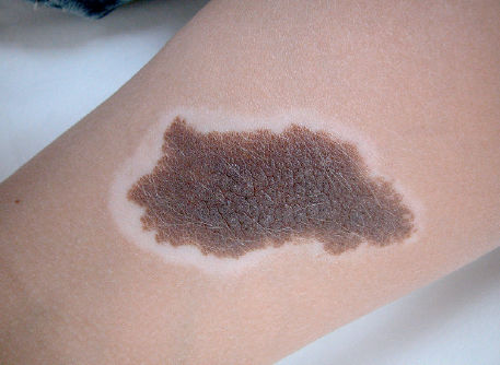 Een jongen met een moedervlek | Nederlands Tijdschrift voor Geneeskunde