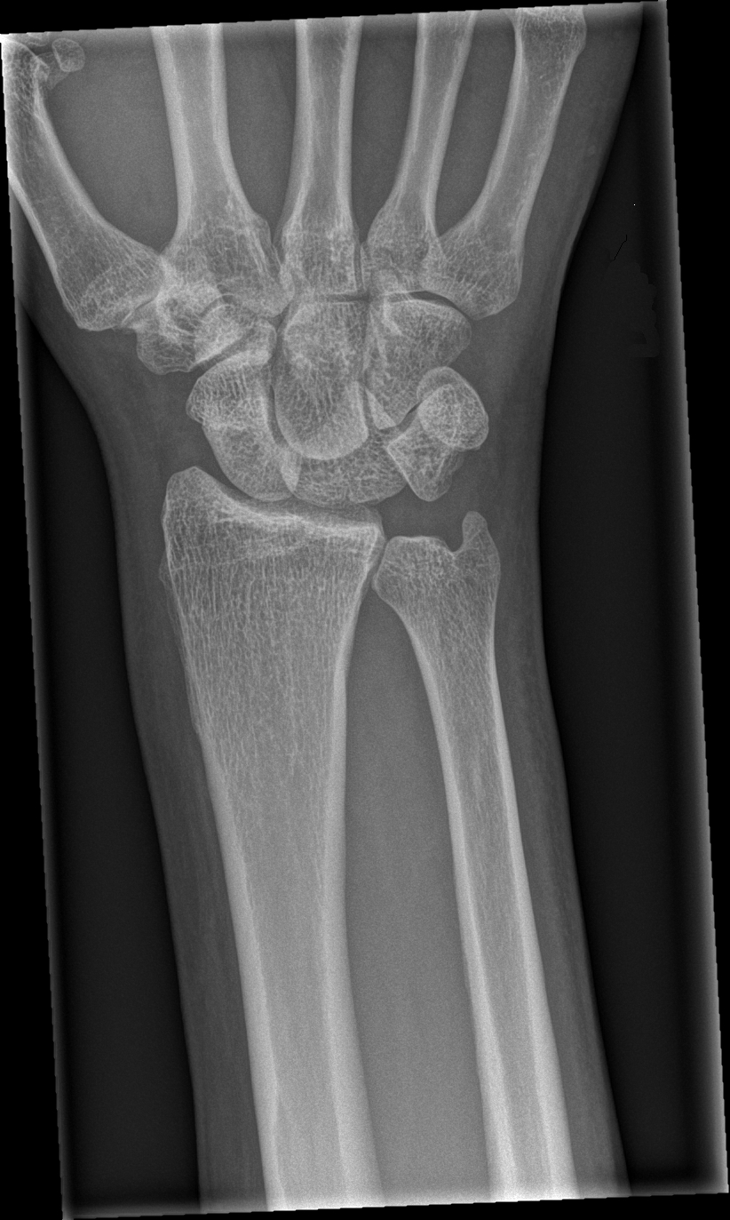 Een pijnlijke, gezwollen pols | Nederlands Tijdschrift voor Geneeskunde