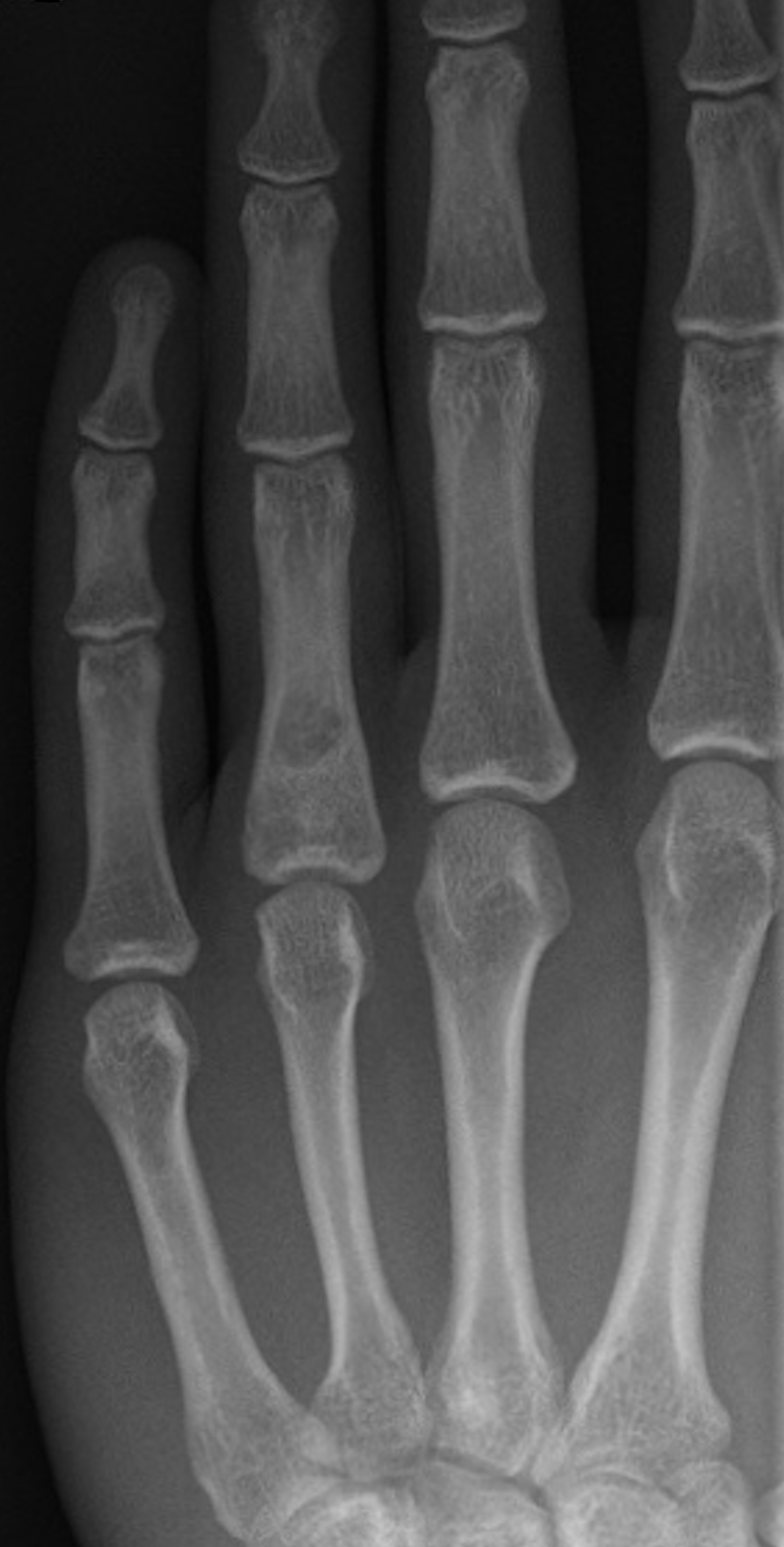 Een pijnlijke ringvinger | Nederlands Tijdschrift voor Geneeskunde