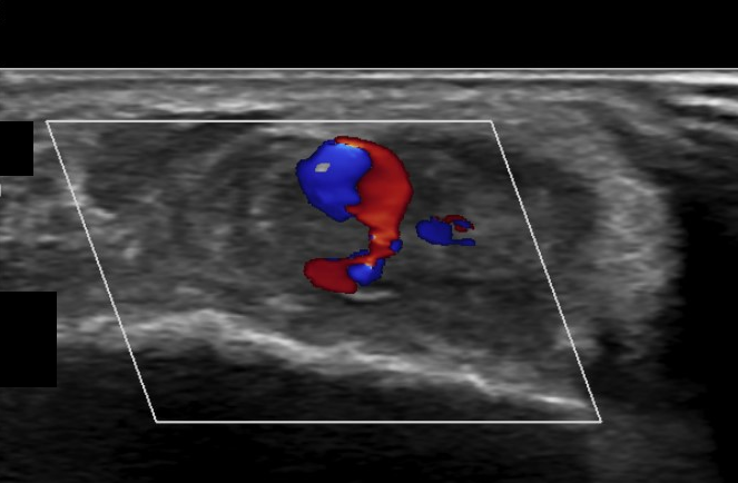 Een man met een bult op zijn slaap | Nederlands Tijdschrift voor ...