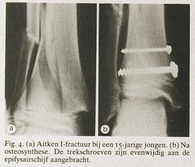 Epifysiolysefracturen van het distale deel van de tibia | NTVG