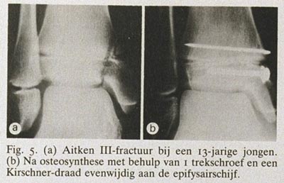 Epifysiolysefracturen van het distale deel van de tibia | NTVG
