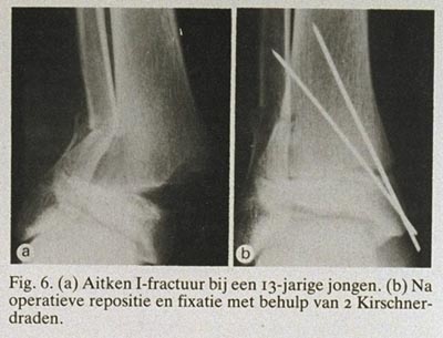 Epifysiolysefracturen van het distale deel van de tibia | NTVG