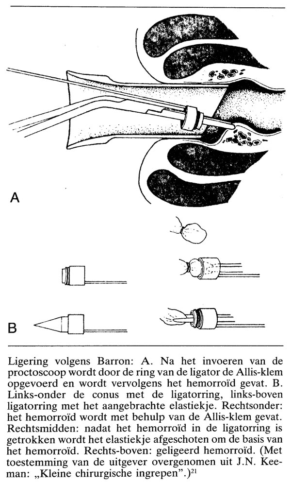 De behandeling van hemorroïden met de ligeringsmethode volgens Barron ...