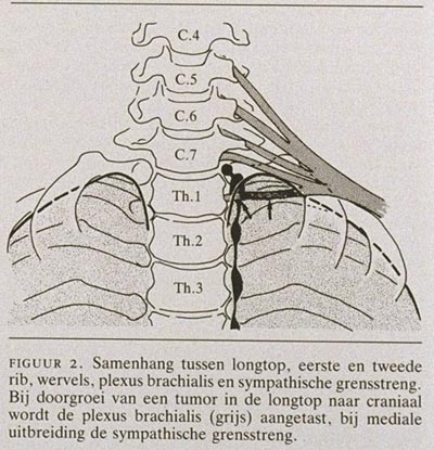 Een miskende oorzaak van pijn in de arm | Nederlands Tijdschrift voor ...