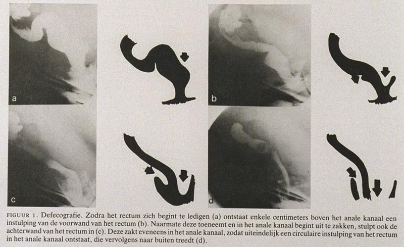 Een radiologisch onderzoek naar het mechanisme van de rectumprolaps en ...