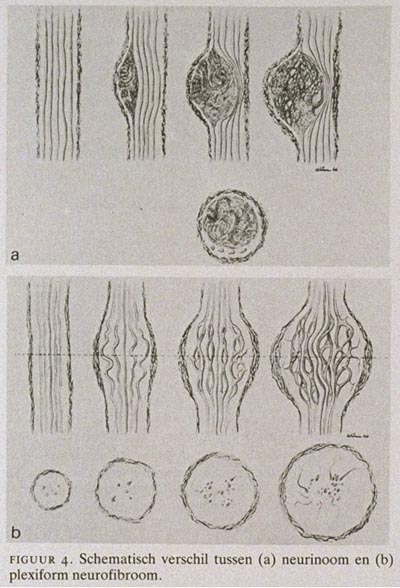 Tumoren van zenuwen in de hand | Nederlands Tijdschrift voor Geneeskunde