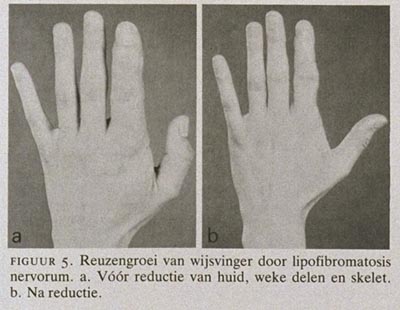 Tumoren van zenuwen in de hand | Nederlands Tijdschrift voor Geneeskunde