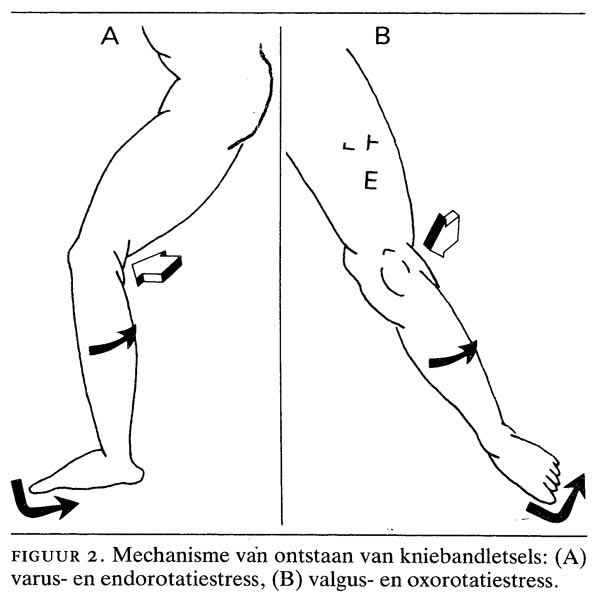 Herstel van de meniscus bij acute instabiliteit van de knie na ...