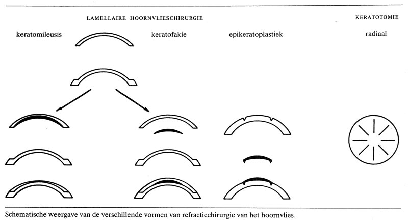 Refractiechirurgie van het hoornvlies | Nederlands Tijdschrift voor ...
