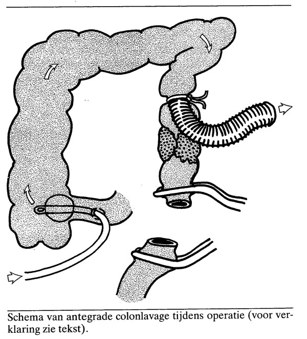 Antegrade lavage tijdens operatie van afwijkingen in het linker deel ...