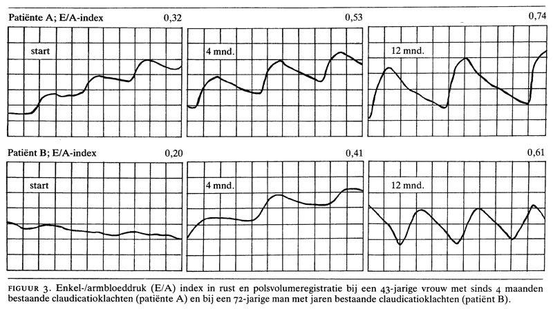 De behandeling van patiënten met claudicatio intermittens door ...