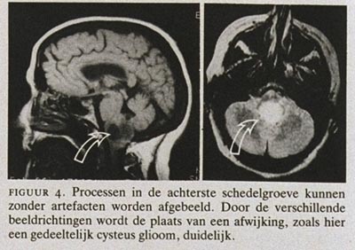 Kernspinresonantietomografie; een jaar ervaring | Nederlands ...