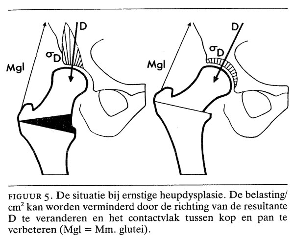 Totale heupprothese, indicaties, resultaten, levensduur | Nederlands ...