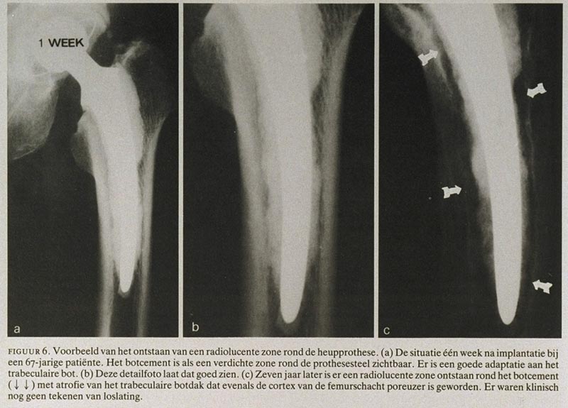 Totale heupprothese, indicaties, resultaten, levensduur | Nederlands ...