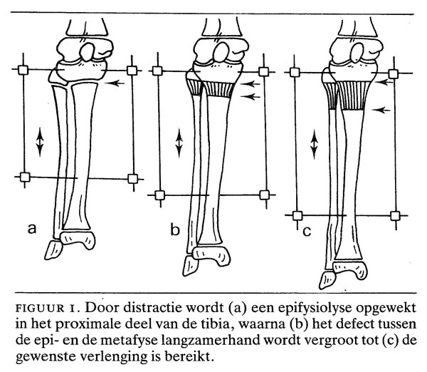 Distractie-epifysiolyse, een nieuwe methode voor beenverlenging en ...