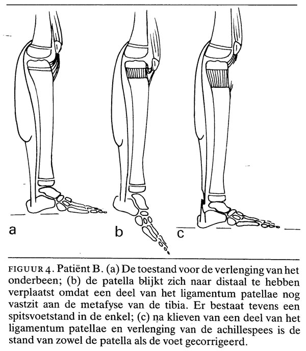 Distractie-epifysiolyse, een nieuwe methode voor beenverlenging en ...