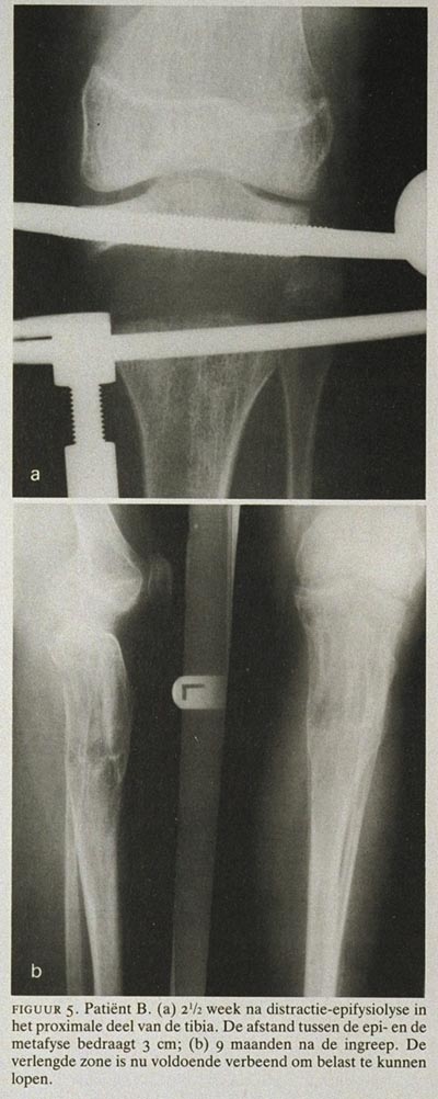 Distractie-epifysiolyse, een nieuwe methode voor beenverlenging en ...