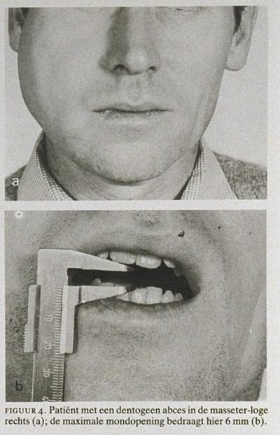 Trismus als symptoom | Nederlands Tijdschrift voor Geneeskunde