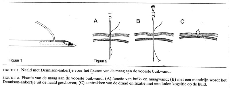 Percutane endoscopische gastrostomie | Nederlands Tijdschrift voor ...