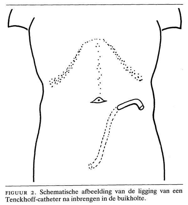 Complicaties na het inbrengen van een Tenckhoff-catheter voor ...