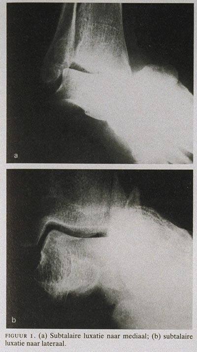 De subtalaire luxatie en luxatiefractuur | Nederlands Tijdschrift voor ...
