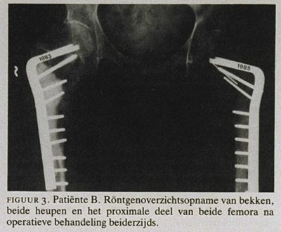 Palliatieve behandeling van skeletmetastasen bij patiënten met ...