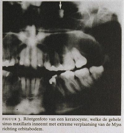 Dentogene cysten | NTVG