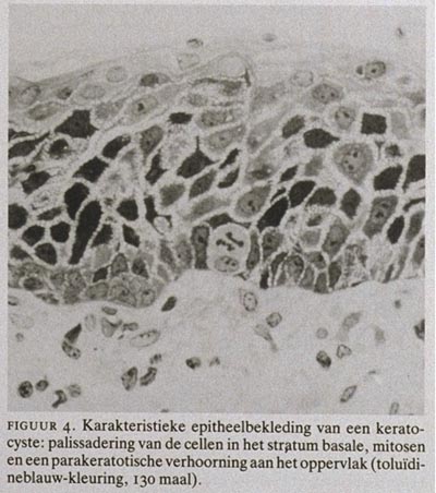 Dentogene cysten | NTVG