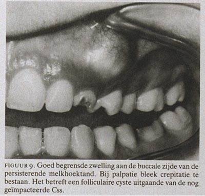Dentogene cysten | NTVG