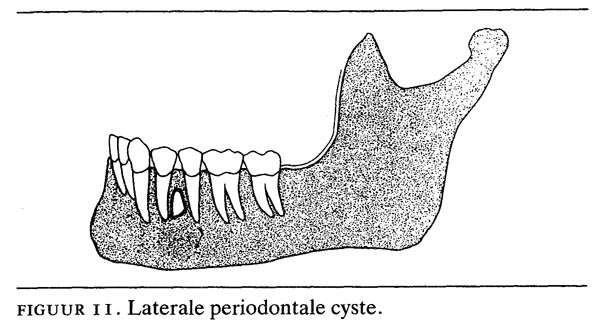 Dentogene cysten | NTVG