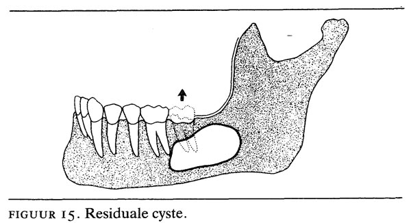Dentogene cysten | NTVG