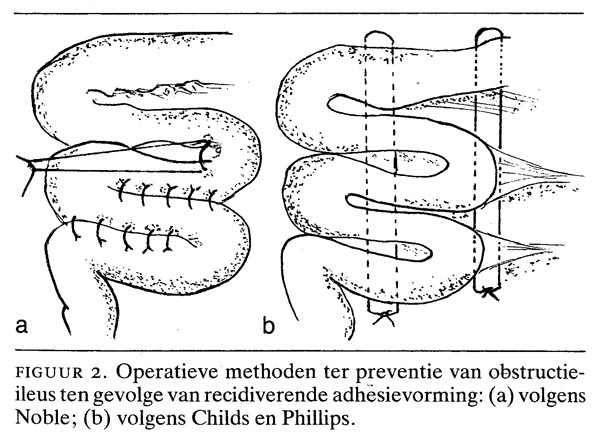 Recidiverende obstructie-ileus door adhesies | Nederlands Tijdschrift ...