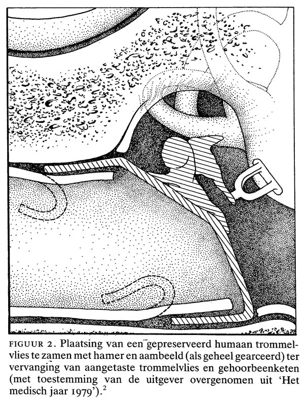 Tympanoplastieken met behulp van gepreserveerde trommelvliezen ...