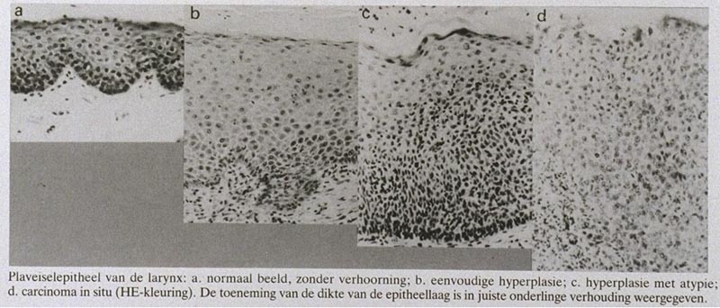 Hyperplasie van het plaveiselepitheel van de larynx; het belang van ...