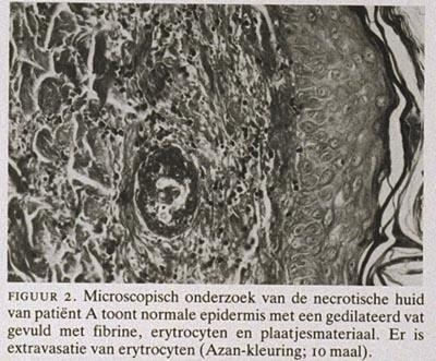 Huidnecrose tijdens toediening van vasopressine | Nederlands ...