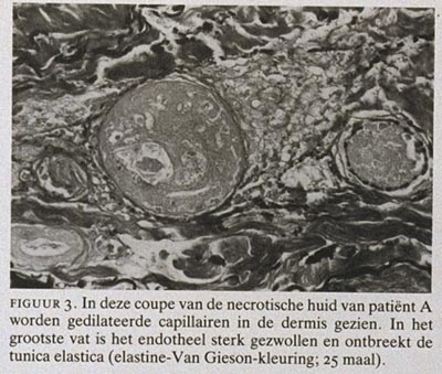 Huidnecrose tijdens toediening van vasopressine | Nederlands ...