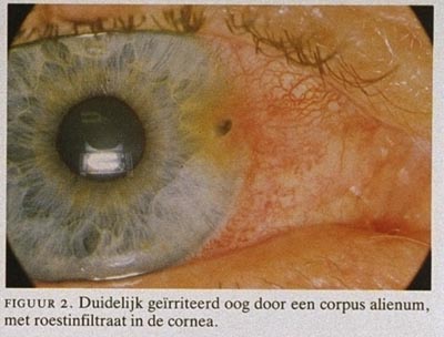 Acute traumata in de oogheelkunde | Nederlands Tijdschrift voor Geneeskunde