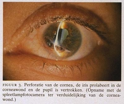 Acute traumata in de oogheelkunde | NTVG